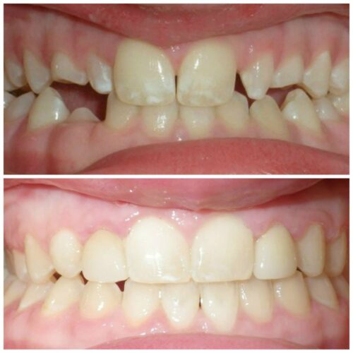 Orthodontic Before & After Photos