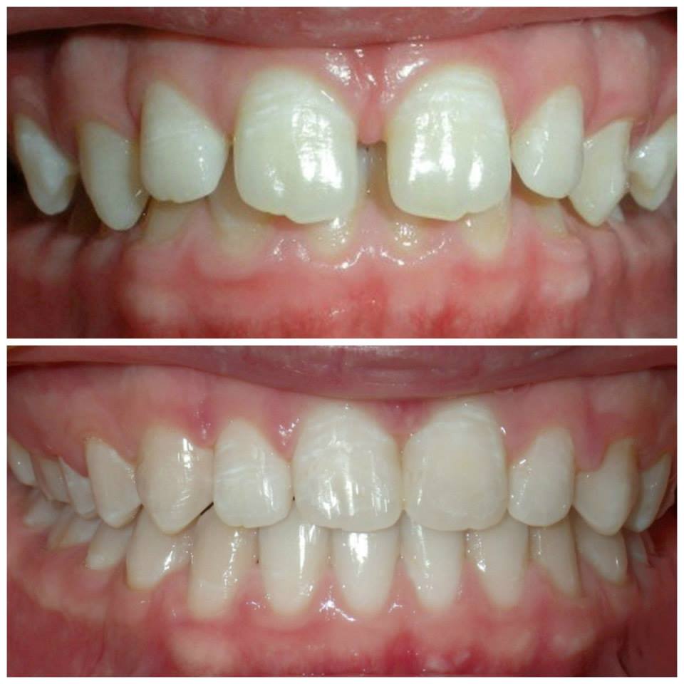Orthodontic Before & After Photos