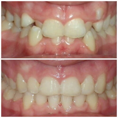 Orthodontic Before & After Photos